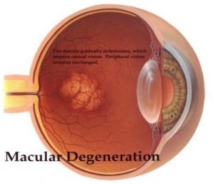 Macular Degeneration – Dr Peter Macken & Associates